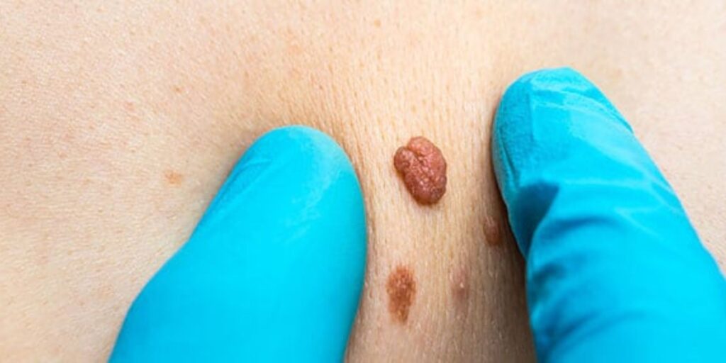 Anal Skin Tags: Causes, Symptoms, and Treatment Options